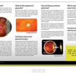 Cataract & Glaucoma Surgery Brochure (8.5″x14″) - Patient Education ...